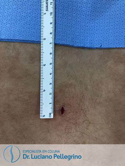 Cirurgia Minimamente Invasiva Da Coluna Dr Luciano Pellegrino