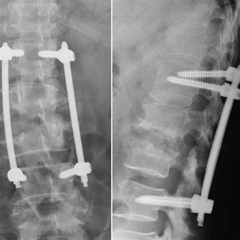 Percutaneous Screw Fixation With Transforaminal Debridement And Vacuum