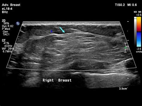 Atlas Of Breast Cancer Early Detection