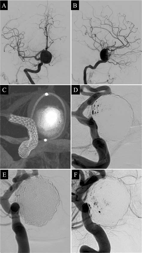 Digital Subtraction Angiography Images Of The Aneurysm Before And