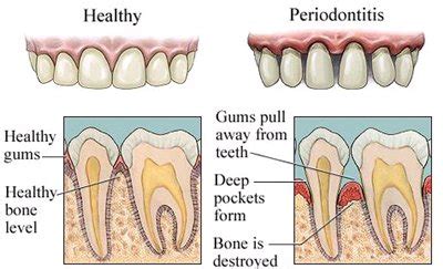 Signs Symptoms Of Periodontal Disease Manchester NH Jason Sudati