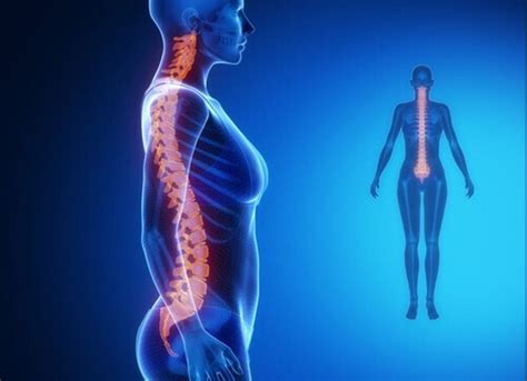 Artrosis De Columna Qu Es S Ntomas Y Tratamiento Top Doctors