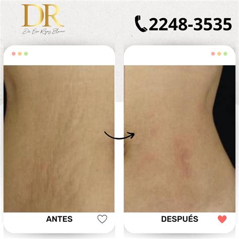 Láser Fotona puede realizar este increíble cambio Dr Eric Rojas