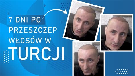 Przeszczep W Os W W Turcji Dni Po Youtube
