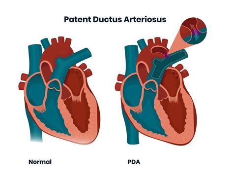 Patent Ductus Arteriosus With Normal Heart Anatomy Illustration The