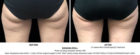 Does CoolSculpting Really Work CoolSculpting Reviews