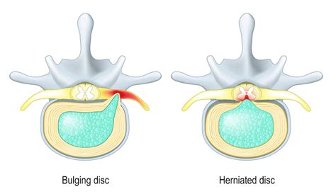 Key Differences Between A Herniated And Bulging Disc A Sufferer In
