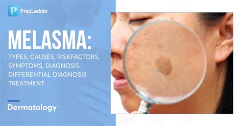 Melasma Types Causes Risk Factors Symptoms Diagnosis