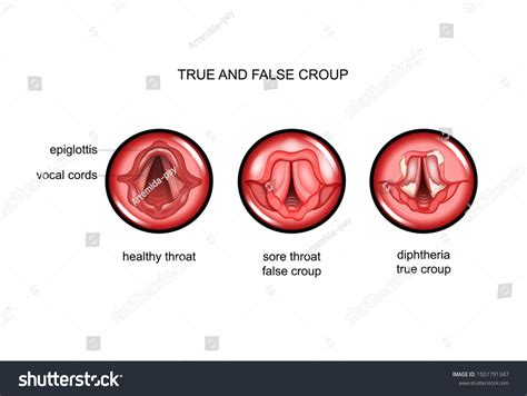 Vector Illustration Diphtheria True False Croup Stock Vector Royalty
