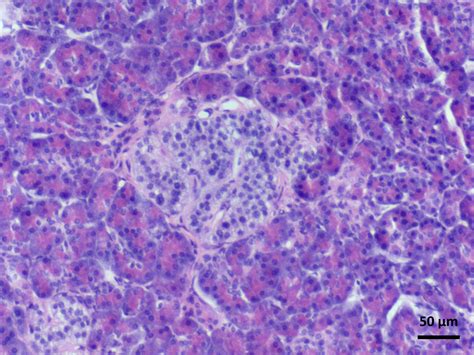 Hemorrhagic Pancreatitis Histology
