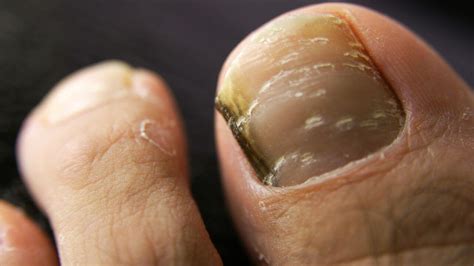 Sintetiza más de 51 imágenes sobre hongos en las uñas del pie el