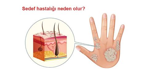 Sedef Hastal Psoriasis Nedir Belirtileri Nedenleri Ve Tedavisi