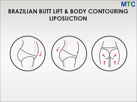 Brazilian Butt Lift In Tijuana Low Cost BBL By Board Certified Surgeons