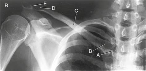Ap Clavicle Diagram Quizlet