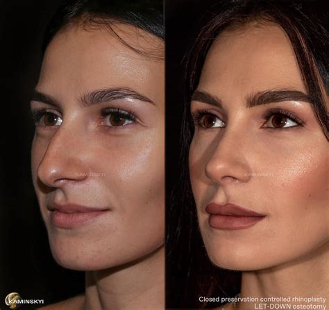 Closed Rhinoplasty Before And After Rhinoplasty 1 Year After Surgery
