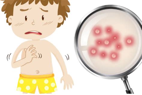 Varicela Semne Simptome Cauze Tratament Repere Medicale