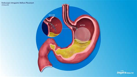 Endoscopic Intragastric Balloon Placement Orbera Inspira Health