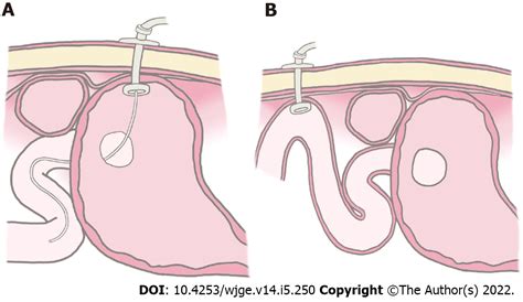 Percutaneous Endoscopic Gastrostomy And Jejunostomy Indications And