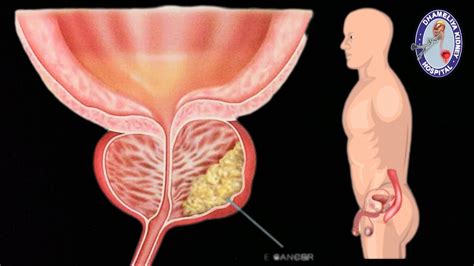 Radical Prostatectomy Animation Prostste Cancer Laparoscopic Radical