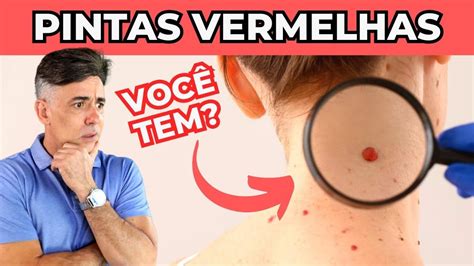 PINTAS VERMELHAS QUAIS AS CAUSAS E COMO TRATAR Dr Dayan Siebra