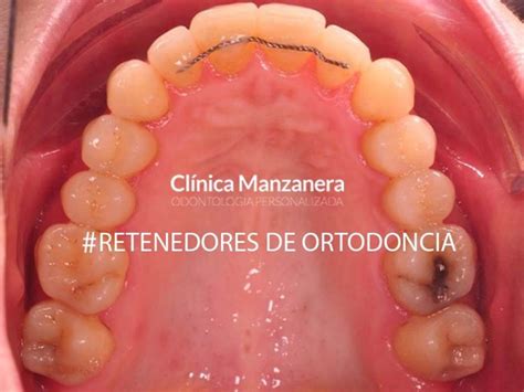 Retenedores Dentales Tipos De Retenedores Ortodoncia
