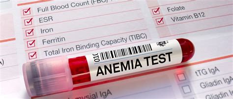 Anemia objawy i leczenie Przyczyny niedokrwistości