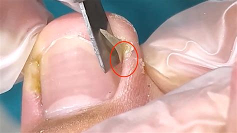 Daily Pedicure TutorialIngrown Nails Treatment The Position Is Very