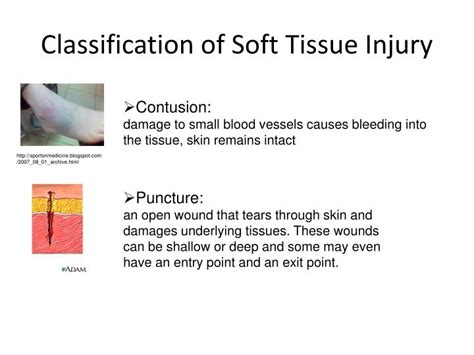 PPT Soft Tissue Injury PowerPoint Presentation ID 1634436