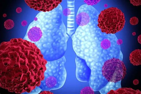Viêm phổi bệnh viện Nguyên nhân triệu chứng chẩn đoán và hướng dẫn
