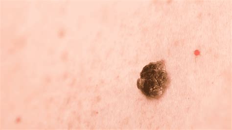 Effective Seborrheic Keratosis Treatment At Reimagine Clinic