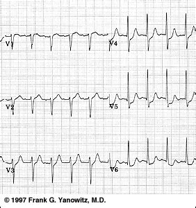 12 Lead EKG Flashcards Quizlet