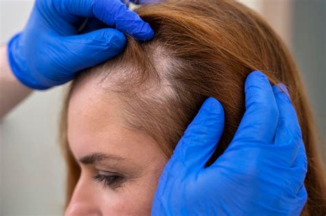 Foliculite Capilar Saiba Como Tratar A Doen A Esteticare