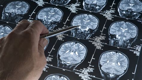 Un D Tecteur Qui Suit Les Cellules Canc Reuses Du Cerveau Nous Avons
