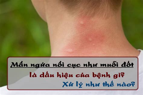 Mẩn Ngứa Nổi Cục Như Muỗi Đốt Là Bệnh Gì Cách Xử Lý
