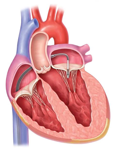 Mitral Regurgitation Symptoms Causes Diagnosis And Treatment Options