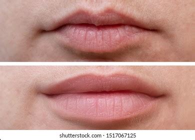 Female Lips Before After Augmentation Result Stock Photo 1517067125