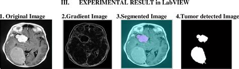 figure 2 from brain tumor detection and segmentation by fuzzy c means fcm algorithm using