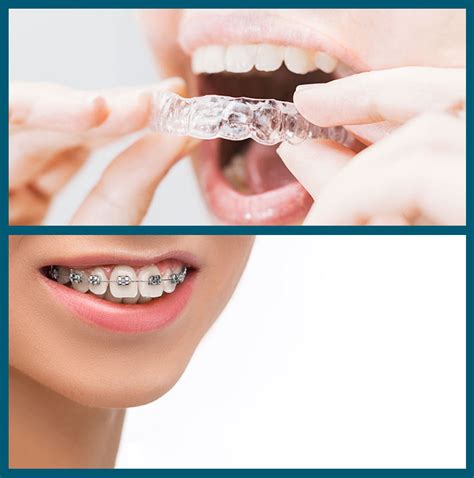 3 ventajas de la Ortodoncia Invisible Clínica Orgaz Dental