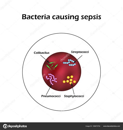 Sepsis Blood Poisoning E Coli Streptococci Pneumococci