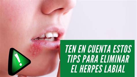 Como Curar Ampollas En Los Labios Los Mejores Remedios Caseros Para