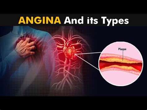 Vincent S Angina Symptoms Causes Treatment Prognosis Science 2025