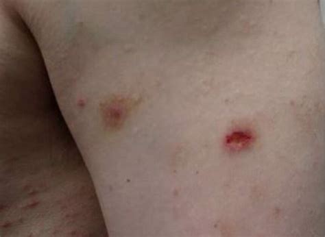 Erythematous Papular Rash