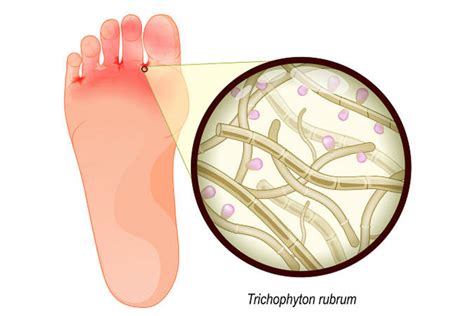 Hongos en los pies Servicio de Podología en Pamplona