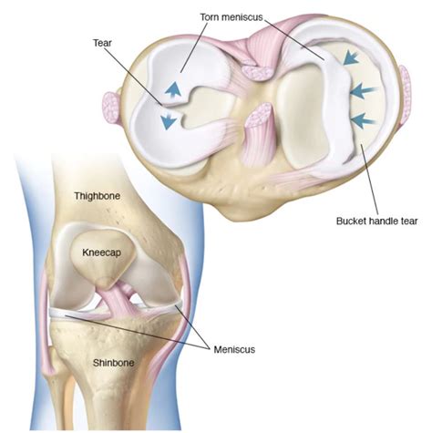 Reparación y reconstrucción meniscal por técnica artroscópica Reus y