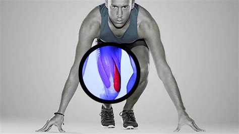 Understanding Vastus Medialis Obliquus VMO Weakness Causes