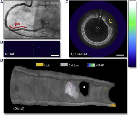 Clinical Characterization Of Coronary Atherosclerosis With Dual