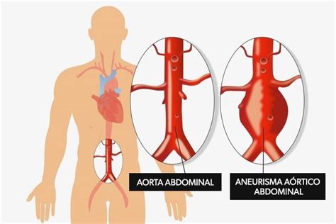 Aneurisma aórtico qué es síntomas y tratamiento Tua Saúde