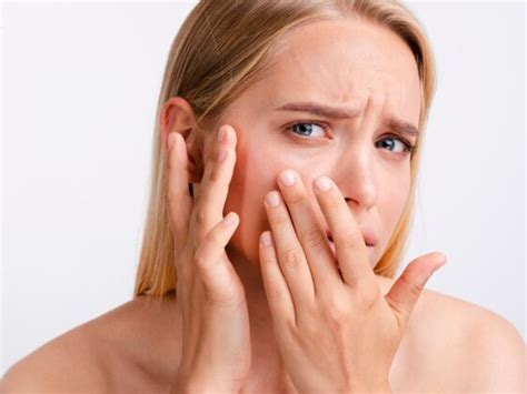 Dermatite Perioral Conheça Causas Sintomas e Tratamentos