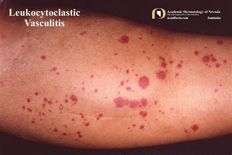 Leukocytoclastic Vasculitis Small Vessel Vasculitis Academic Dermatology Of Nevada