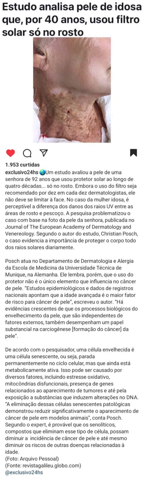 Estudo Analisa Pele De Idosa Que Por Anos Usou Filtro Solar S No